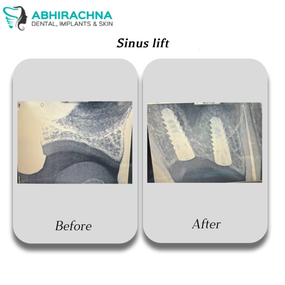 Sinus Lift